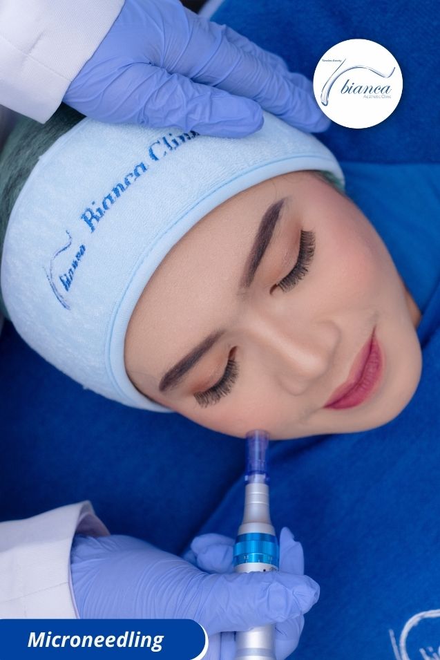 Microneedling - Klinik Kecantikan Bianca
